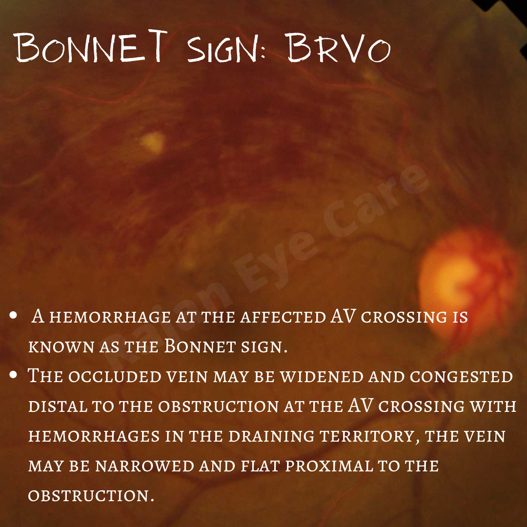 What is Bonnet Sign in BRVO? — Ophthalmobytes