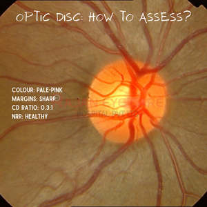 Optic Disc: How to assess? — Ophthalmobytes