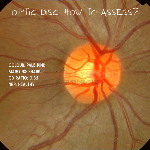 Optic Disc: How to assess? — Ophthalmobytes