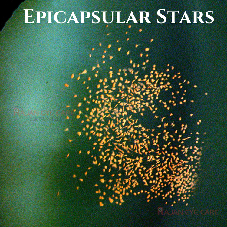 Epicapsular Stars — Ophthalmobytes