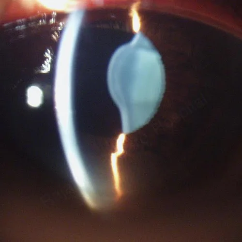 Lens Cone — Ophthalmobytes