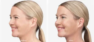 Why Lower Face Botox Matters — Revisions Aesthetics + Wellness