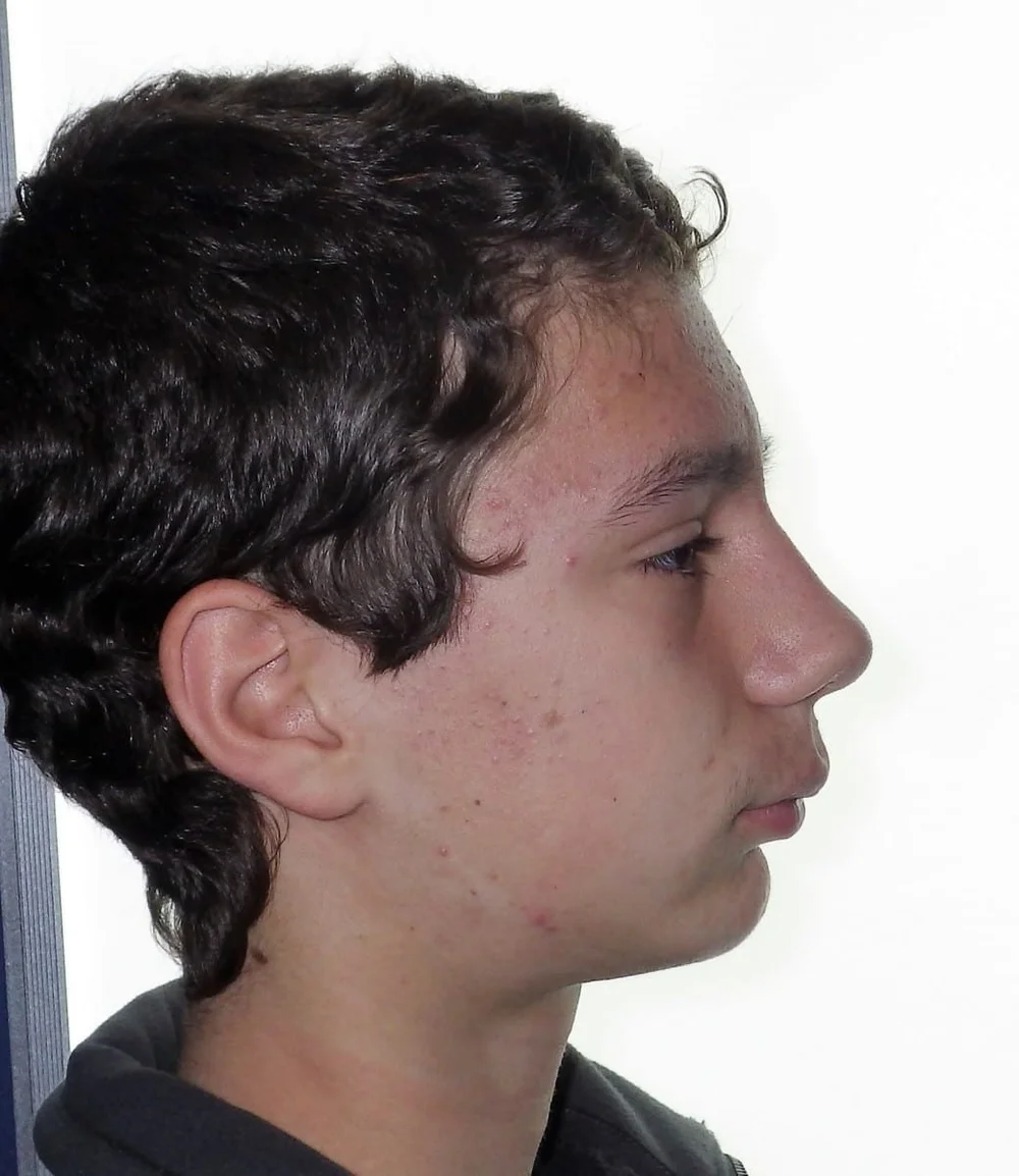 Benefits of Using a Herbst Appliance — Orthodontic Arts