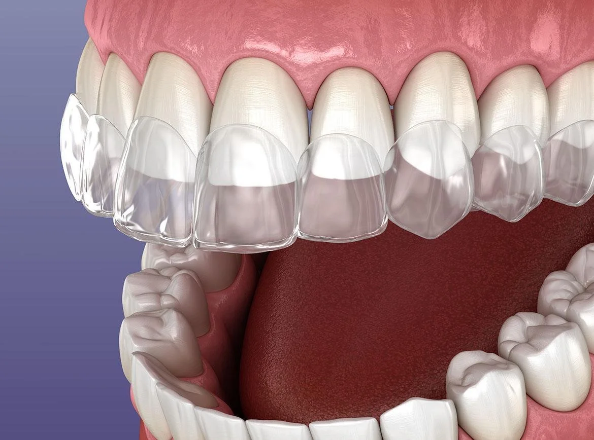 Teeth Straightening After Braces — Orthodontic Arts