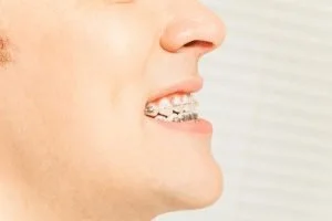 3 Types of Bites in Dentistry and Fixes — Orthodontic Arts