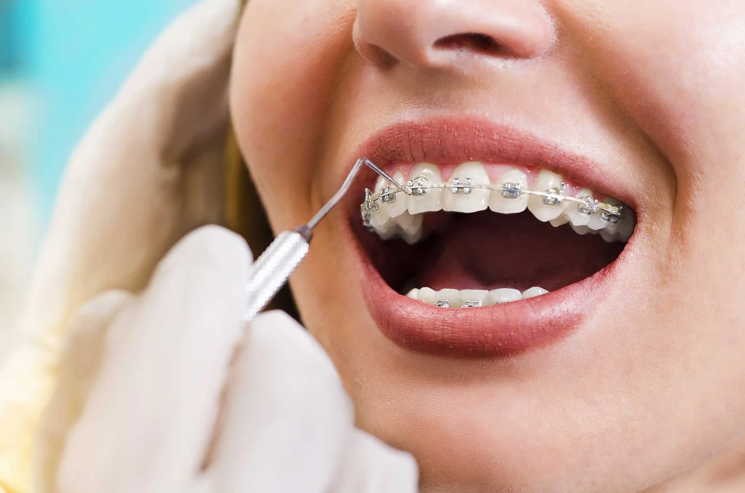 How to Avoid Cavities with Braces — Orthodontic Arts