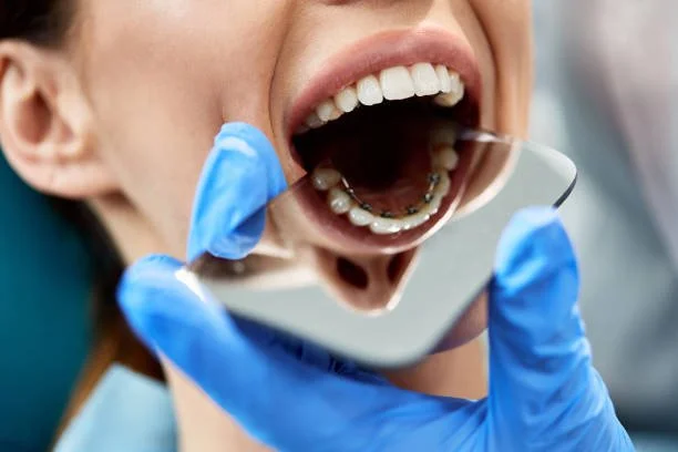 Braces vs Lingual Braces — Orthodontic Arts