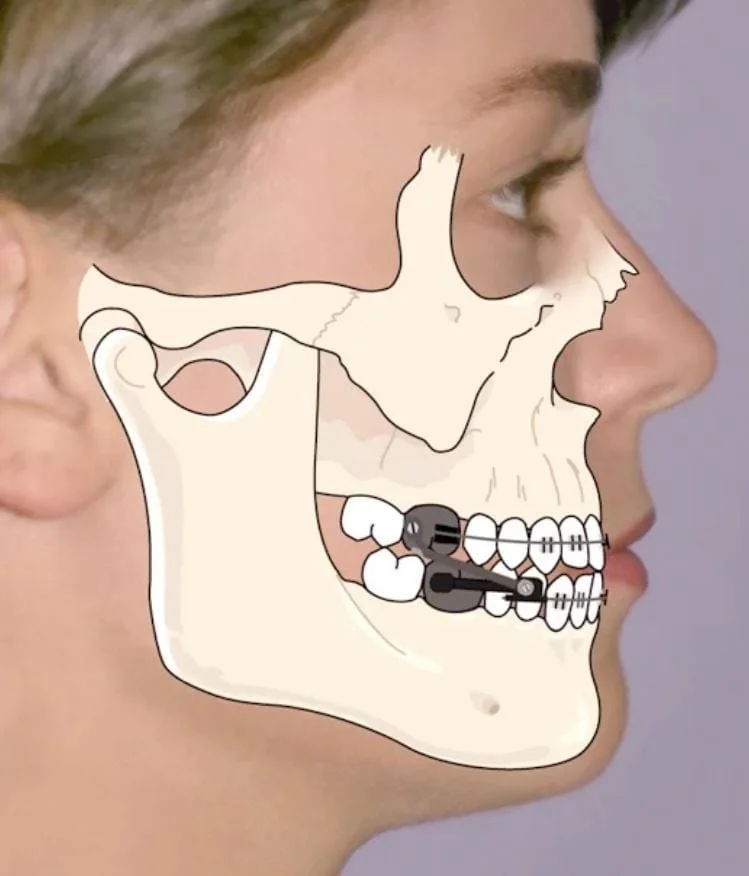 Benefits of Using a Herbst Appliance — Orthodontic Arts