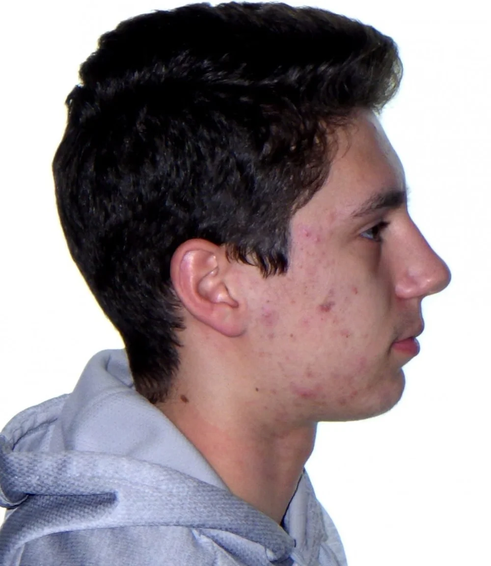 Benefits of Using a Herbst Appliance — Orthodontic Arts