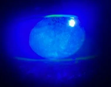 Sore eyes after cataract surgery — Vision Insights