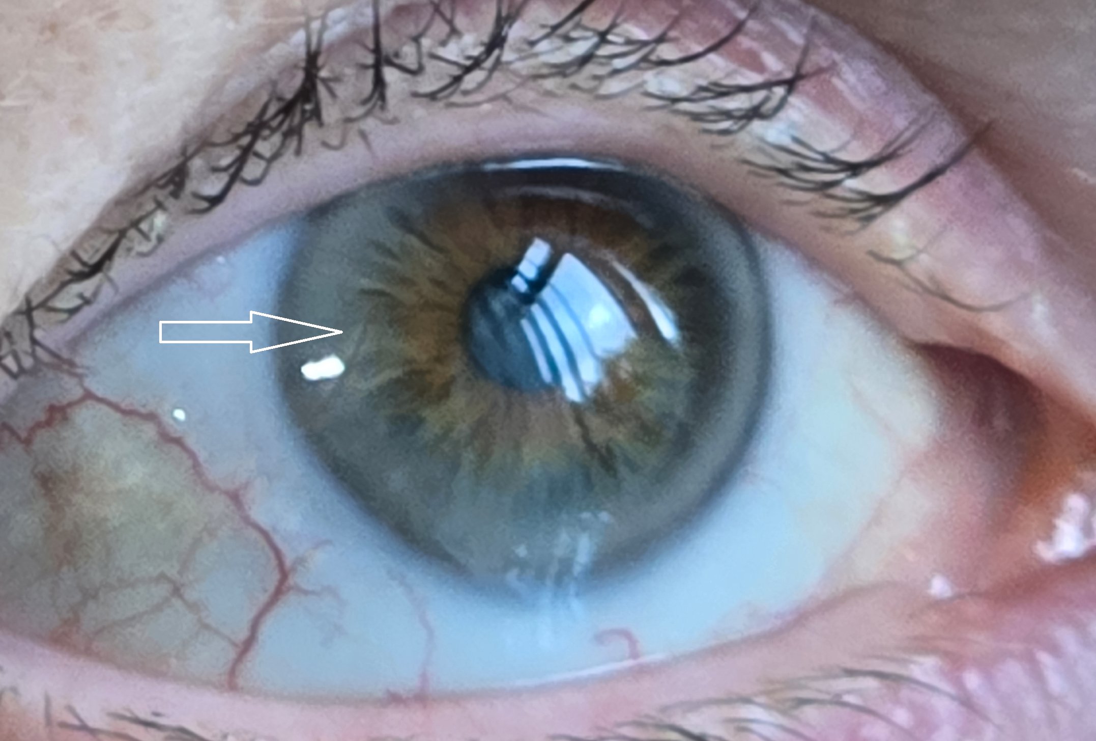 Sore eyes after cataract surgery — Vision Insights