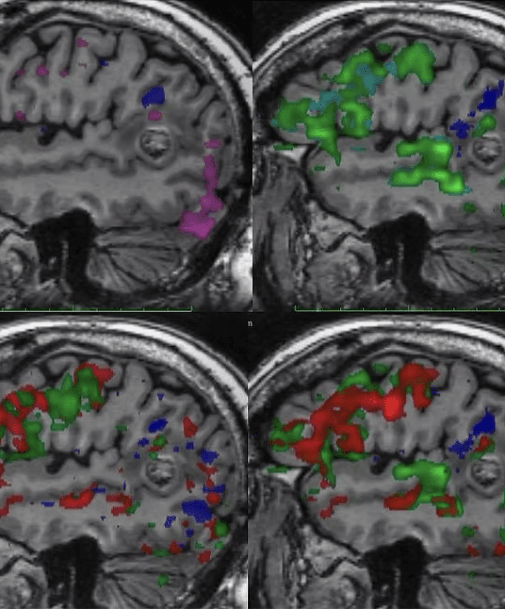 fMRI Resources — American Society of Functional Neuroradiology
