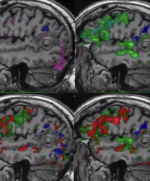 fMRI Resources — American Society of Functional Neuroradiology