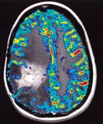 What is Perfusion Imaging? — American Society of Functional Neuroradiology