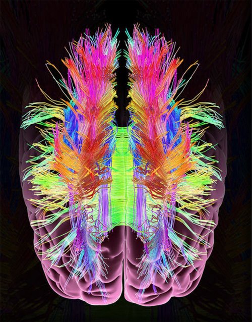 What is Diffusion Imaging? — American Society of Functional Neuroradiology