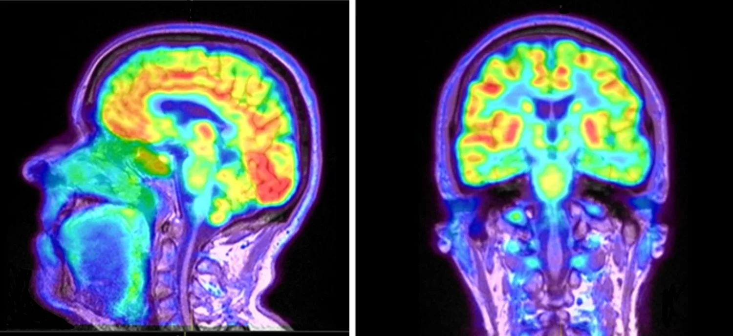 What is PET Imaging? — American Society of Functional Neuroradiology