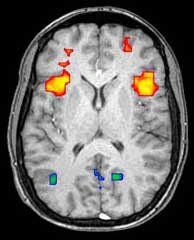 What is BOLD fMRI? — American Society of Functional Neuroradiology