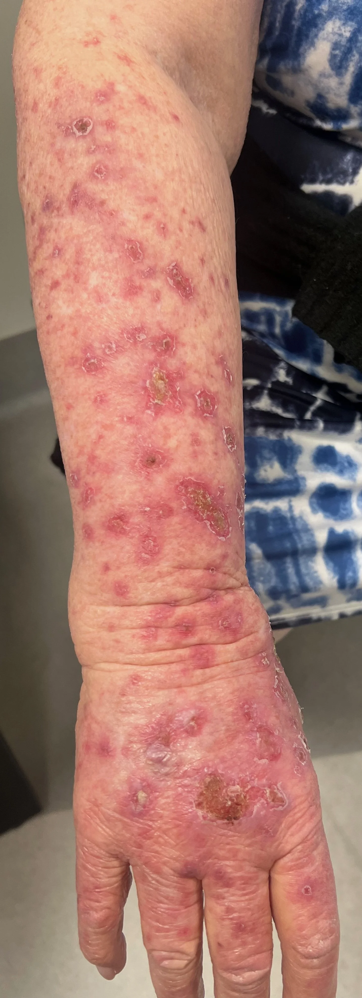 efudix | Effective Skin Care Solutions – Act Now — Dr Emily Shao