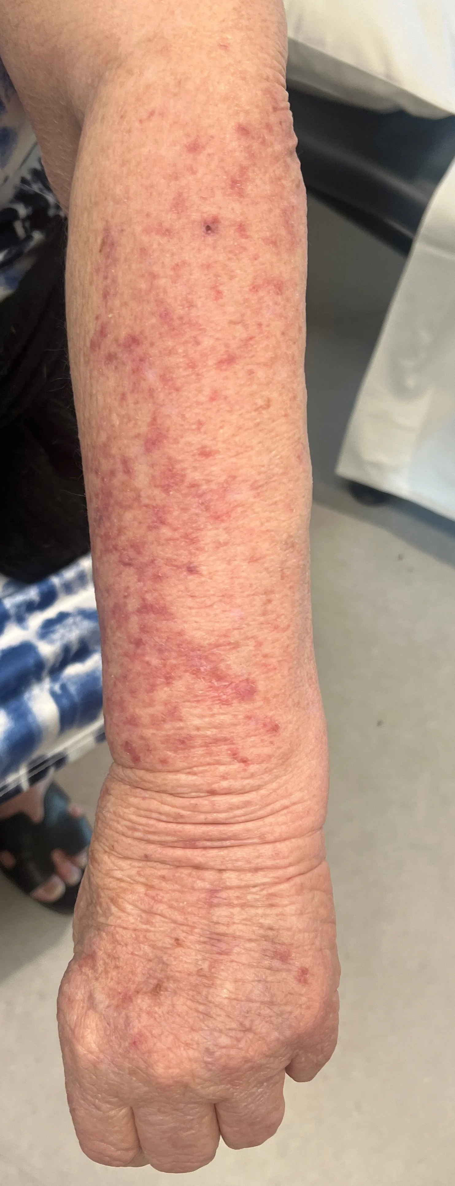 efudix | Effective Skin Care Solutions – Act Now — Dr Emily Shao