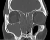Do I Need a CT Sinus Scan? — Girgis ENT