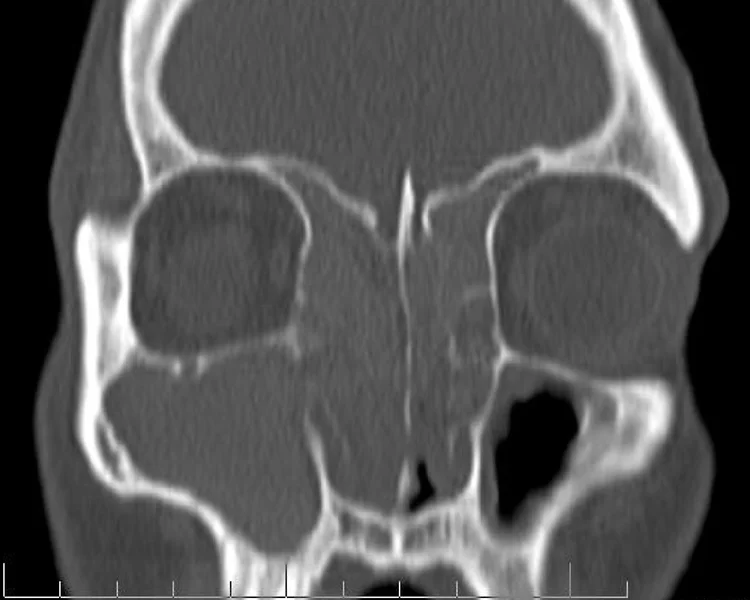 Do I Need a CT Sinus Scan? — Girgis ENT