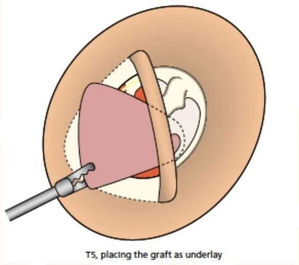 Tympanoplasty — ent4kids