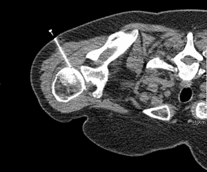 Hydrodilation | Enhance Shoulder Mobility Today — The Radiology Clinic