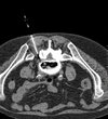 Nerve Root Injections | Consult Nerve Root Relief Today — The Radiology ...