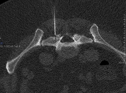 Epidural | Learn About Epidurals Today — The Radiology Clinic