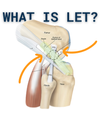 What Is Lateral Extra-Articular Tenodesis (LET) — and Why Is It ...