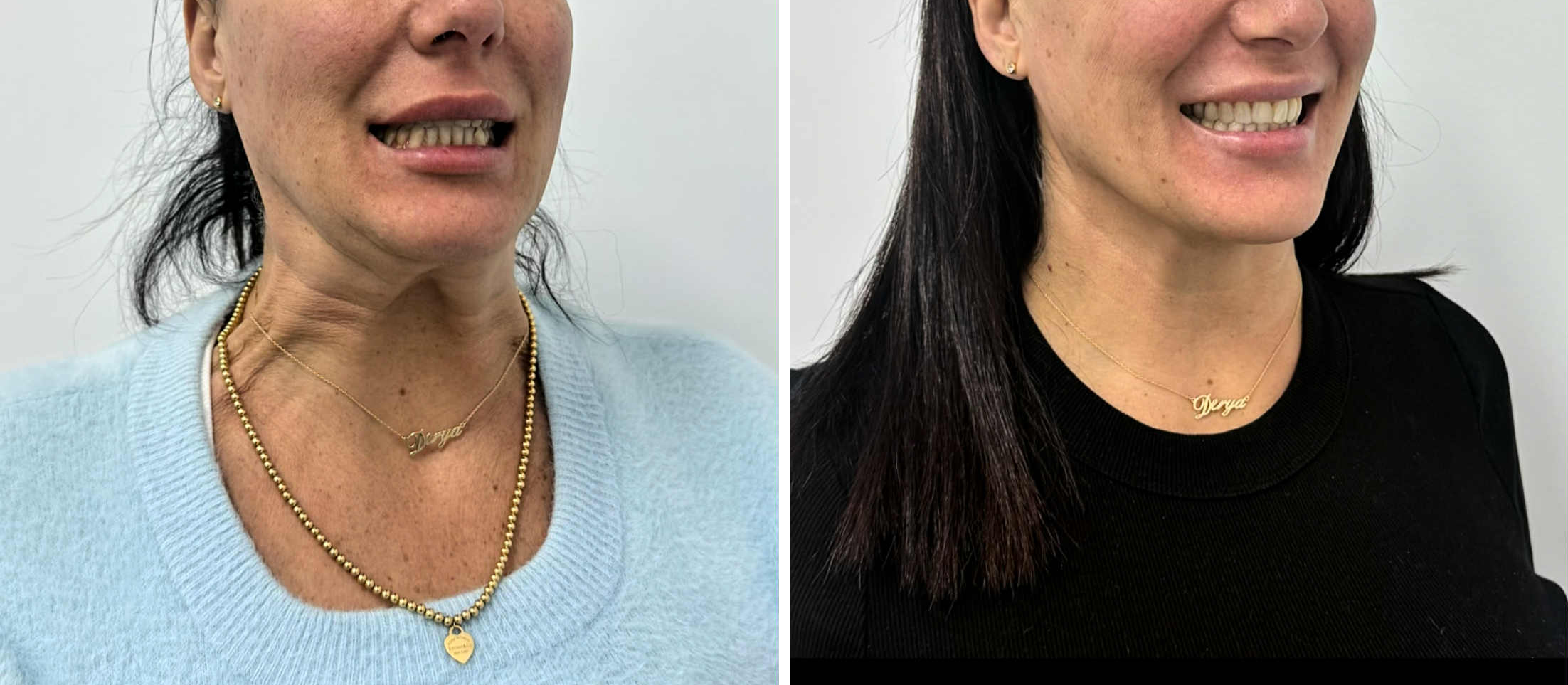 What Are Platysmal Neck Bands? — Aesthetica HQ Cosmetic Clinic