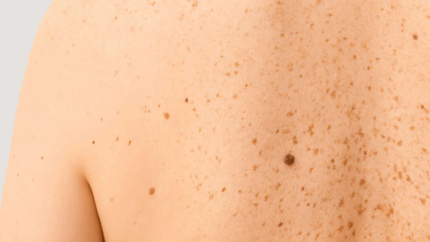ABCDE Rule for Melanoma – Signs to Check in Moles