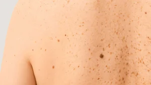 ABCDE Rule for Melanoma – Signs to Check in Moles