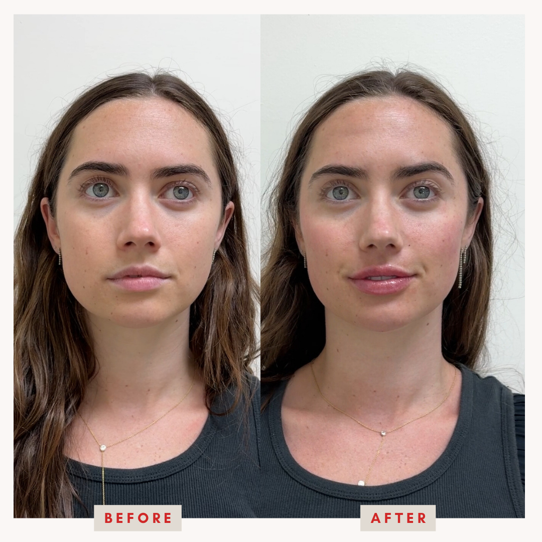 What is facial balancing? — Natural Botox & Fillers Boston | Clemens ...
