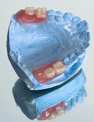 Acrylic Partials | Affordable and Customizable — Denture Crafters