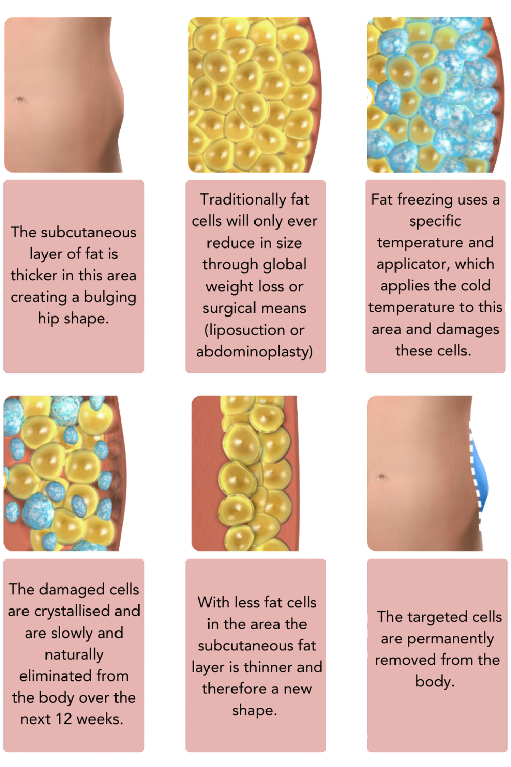Fat Freezing Melbourne I Permanent Fat Loss I Better Than CoolSculpting
