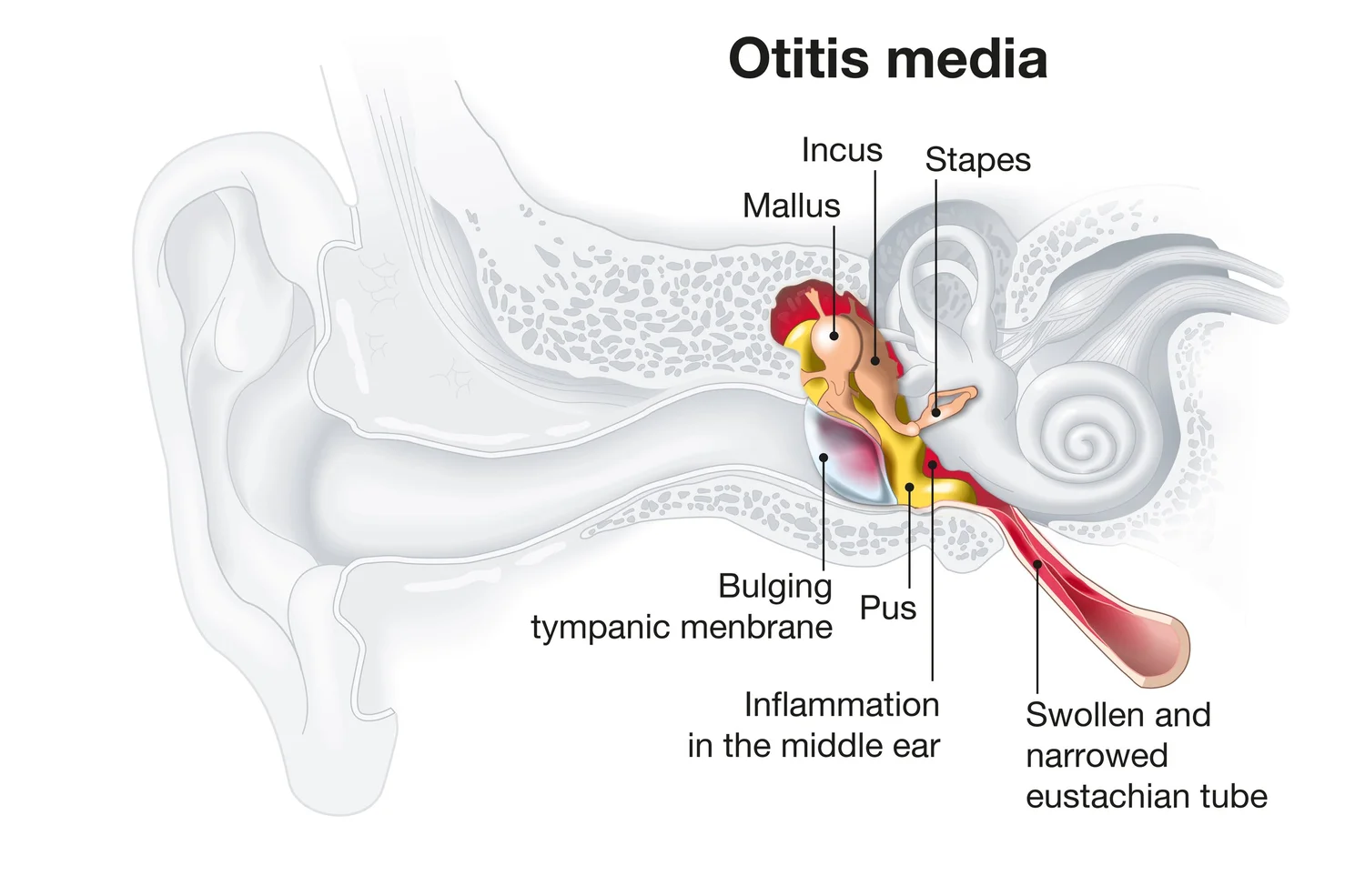 Middle Ear Infection: Symptoms, Causes and How to Treat It — Clear Ears ...