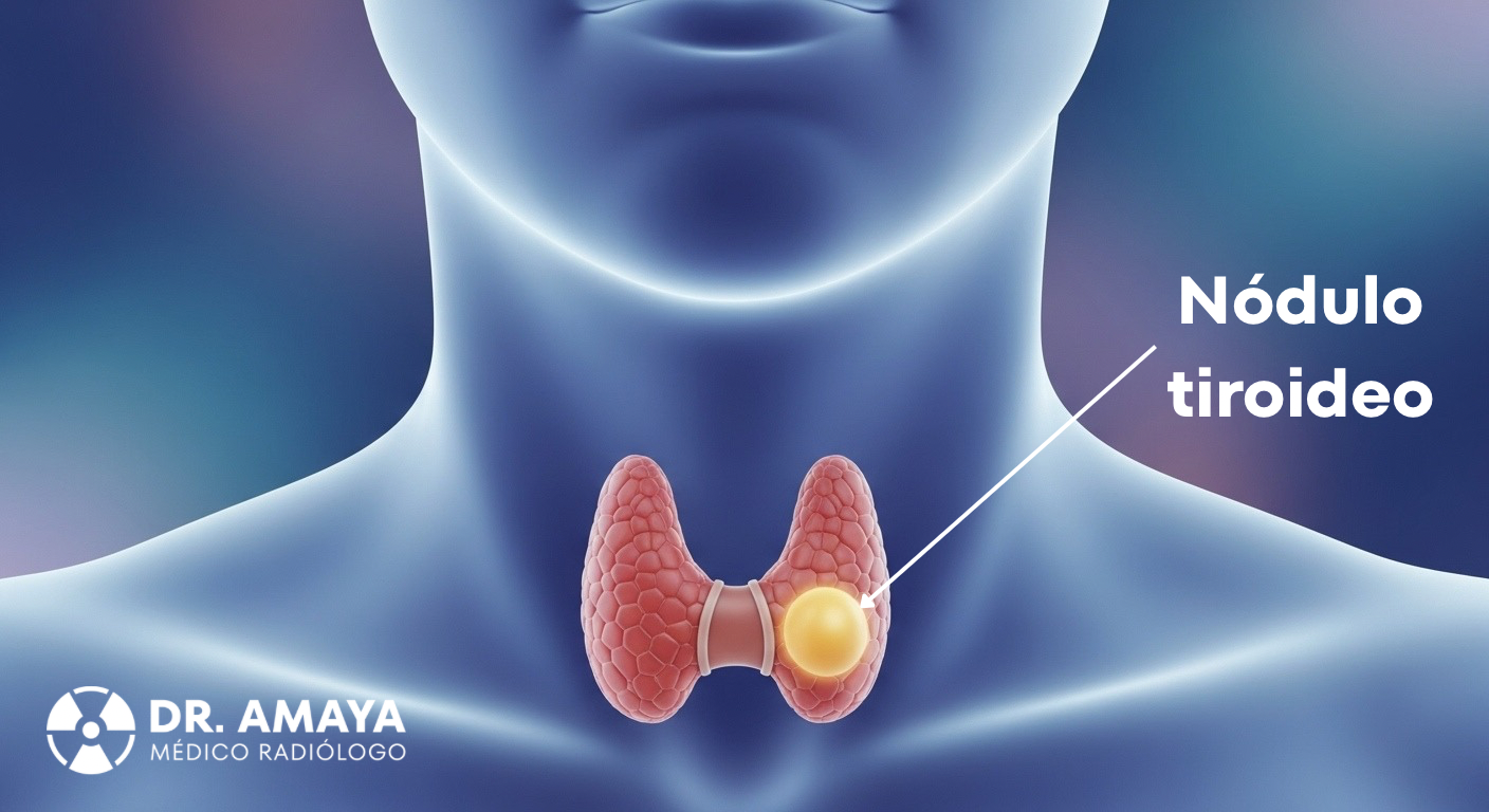 ¿Qué es un nódulo tiroideo? — DR AMAYA - Médico radiólogo