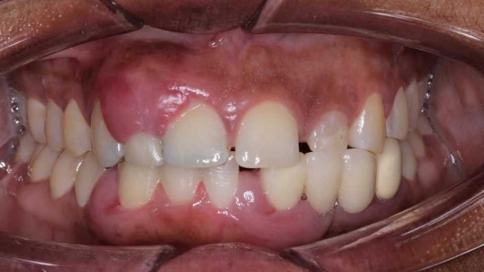 Top Five Causes of Gingival Hyperplasia Explained