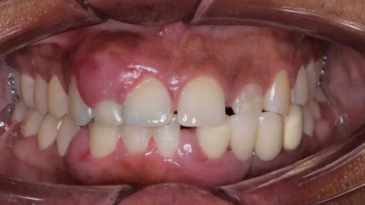 Top Five Causes of Gingival Hyperplasia Explained