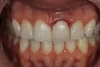 Bleeding After a Dental Crown | Dr. Scott Froum | Midtown NYC