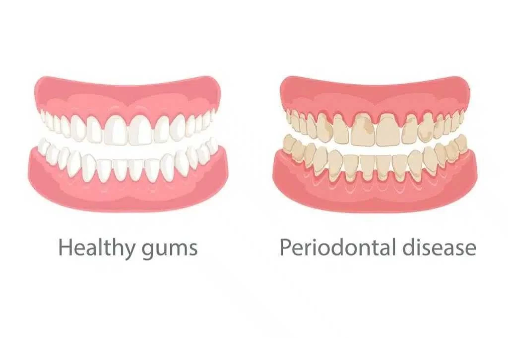 Signs of Gingivitis & How Fast It Can Turn Into Periodontitis