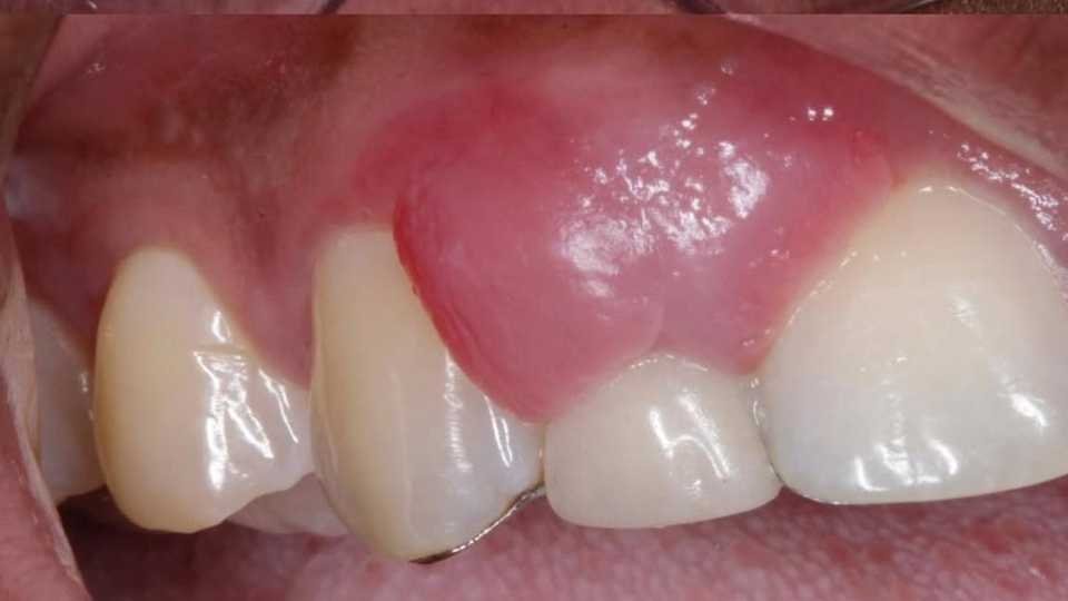 Top Five Causes of Gingival Hyperplasia Explained
