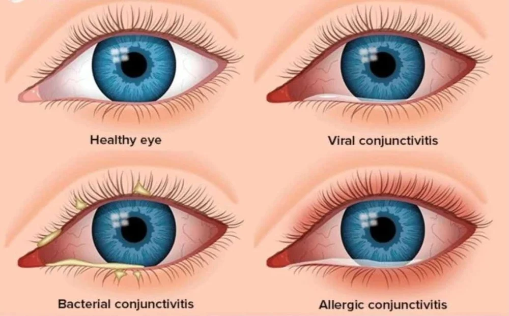 Conjunctivitis | Get Expert Conjunctivitis Care — Eye Specialist Centre ...