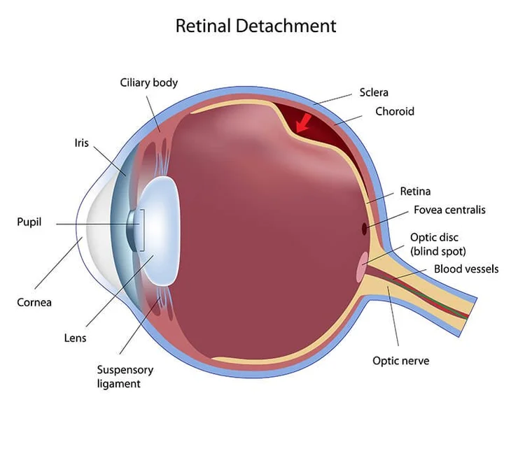 Retinal Detachment | Schedule a Consultation Today — Eye Specialist ...