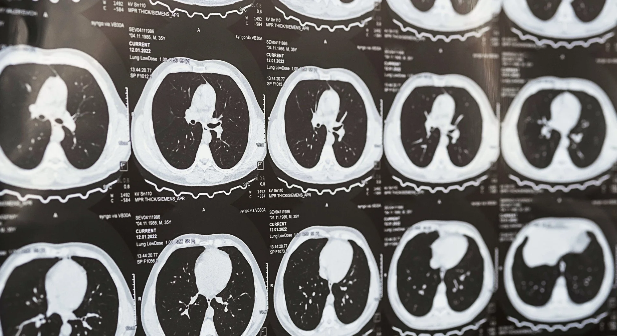 What Is a Chest CT Scan? — Nippon Health