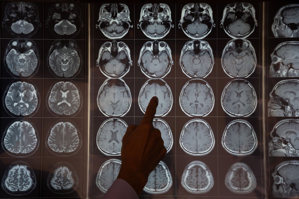 Quantum Technology Boosting Brain Research and Medical Imaging ...
