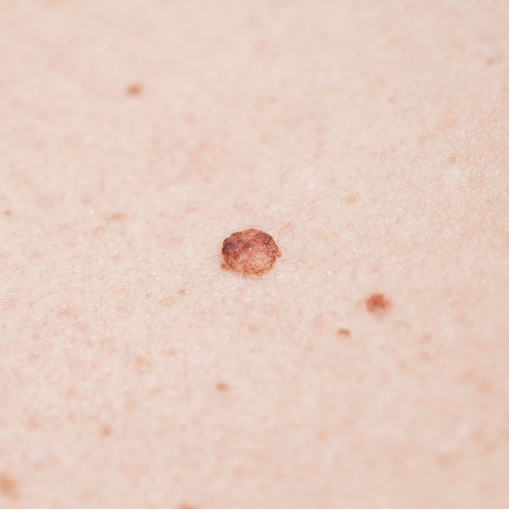 Skin Growths | Discover Solutions Today — OSVI Dermatology and Surgery ...