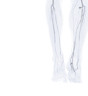 Peripheral Angiography, Angioplasty, Stenting — Anderson Heart & Vascular