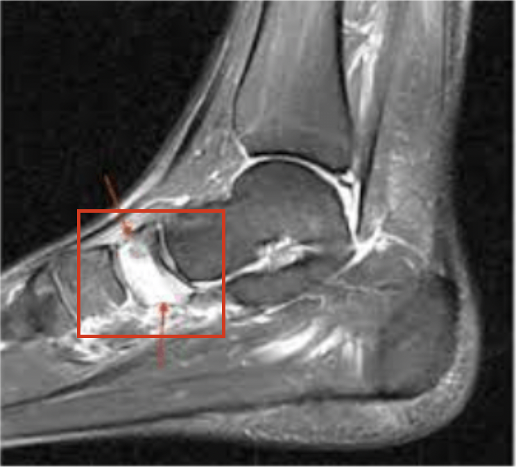 Navicular Injury — Lower Extremity Group